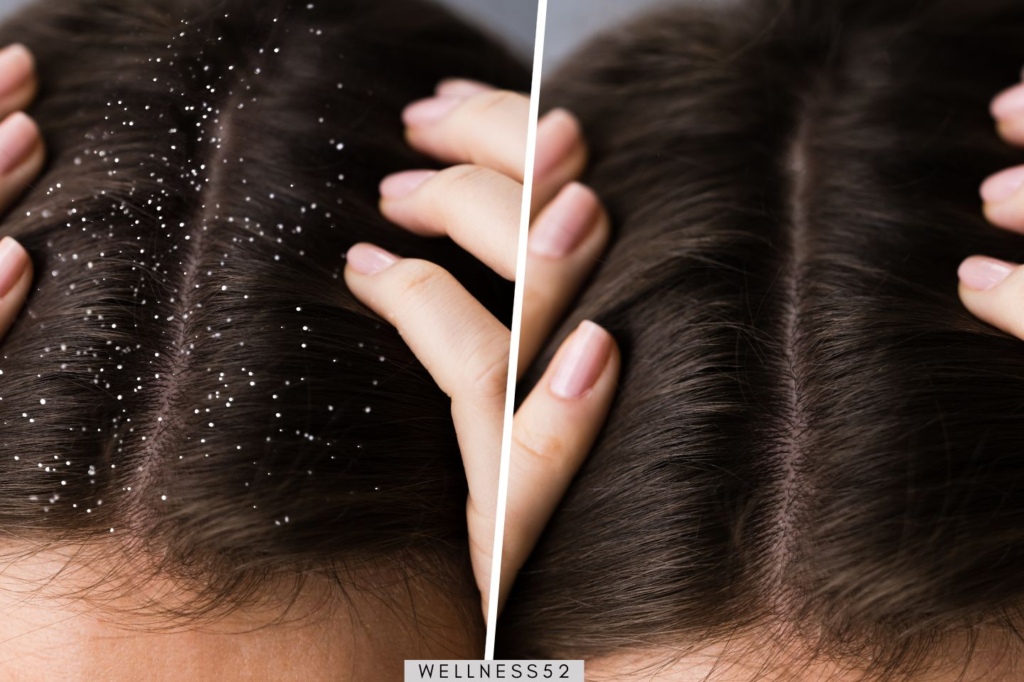 12 Best Dandruff Shampoos for Itchy and Flaky Scalps (2025 Guide)